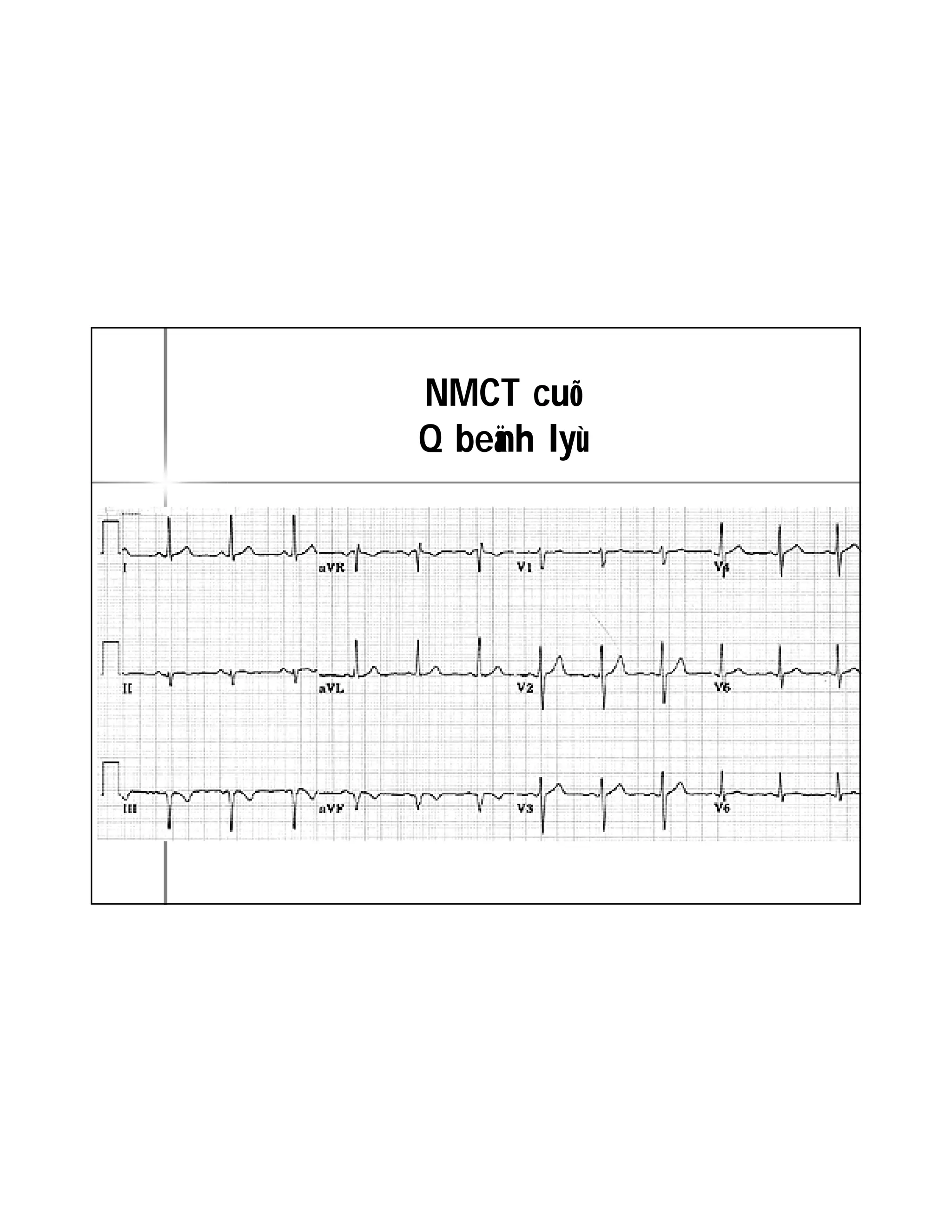ECG TRONG NONSTEMI | PDF