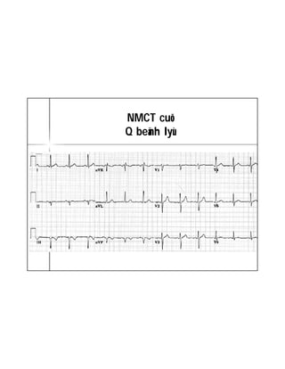 ECG TRONG NONSTEMI | PDF