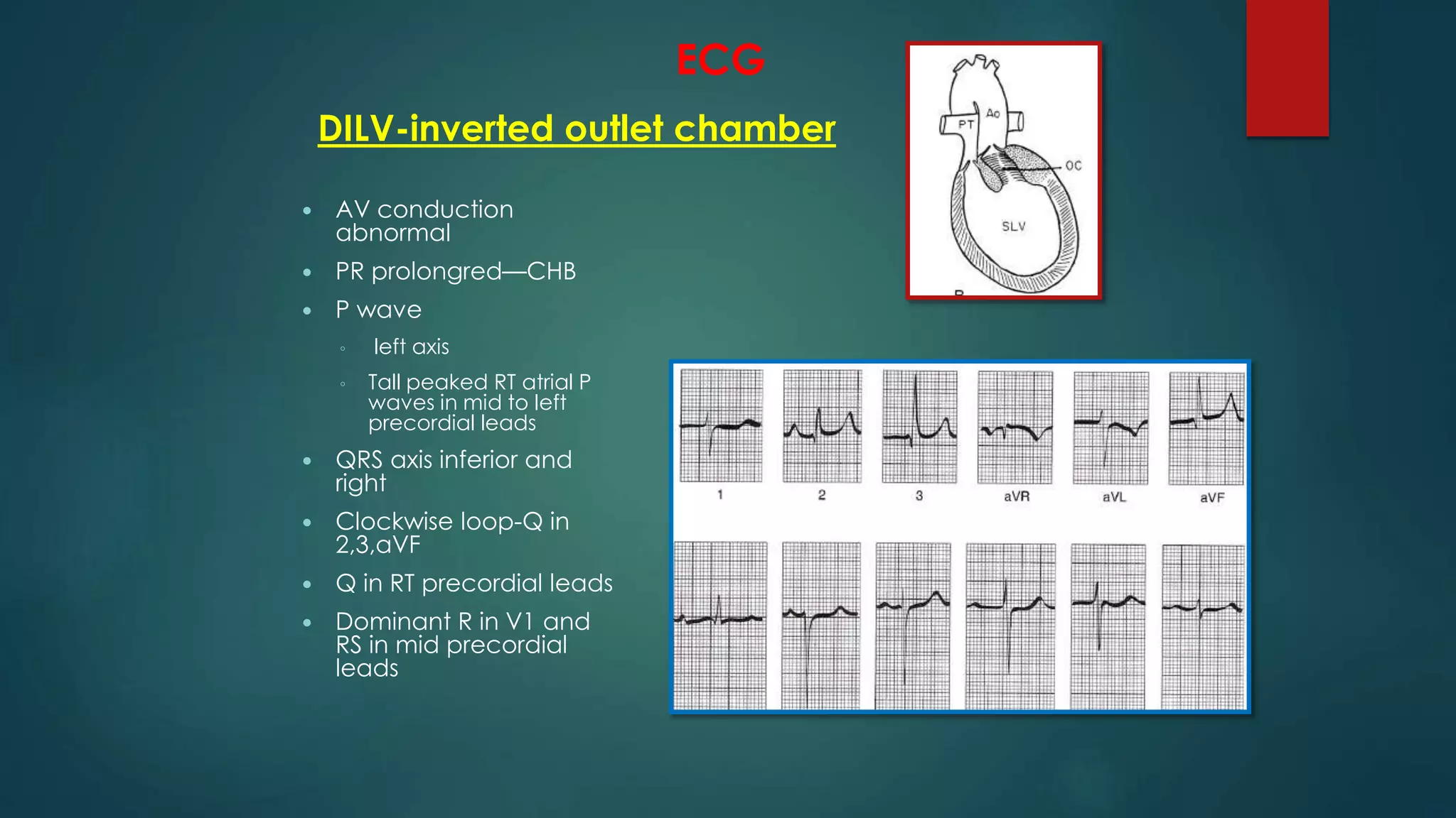 Ecg in single ventricle | PPTX