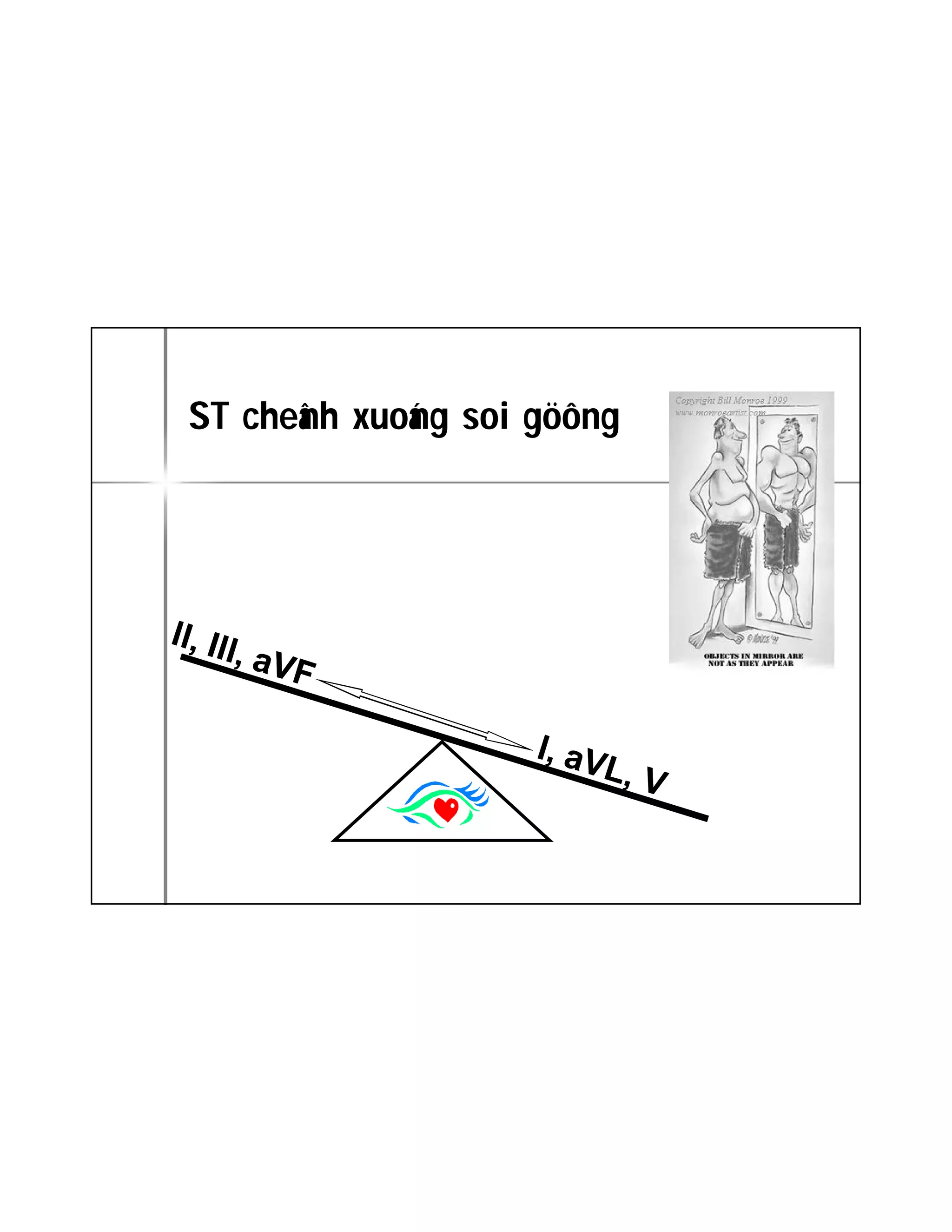 ECG TRONG STEMI | PDF