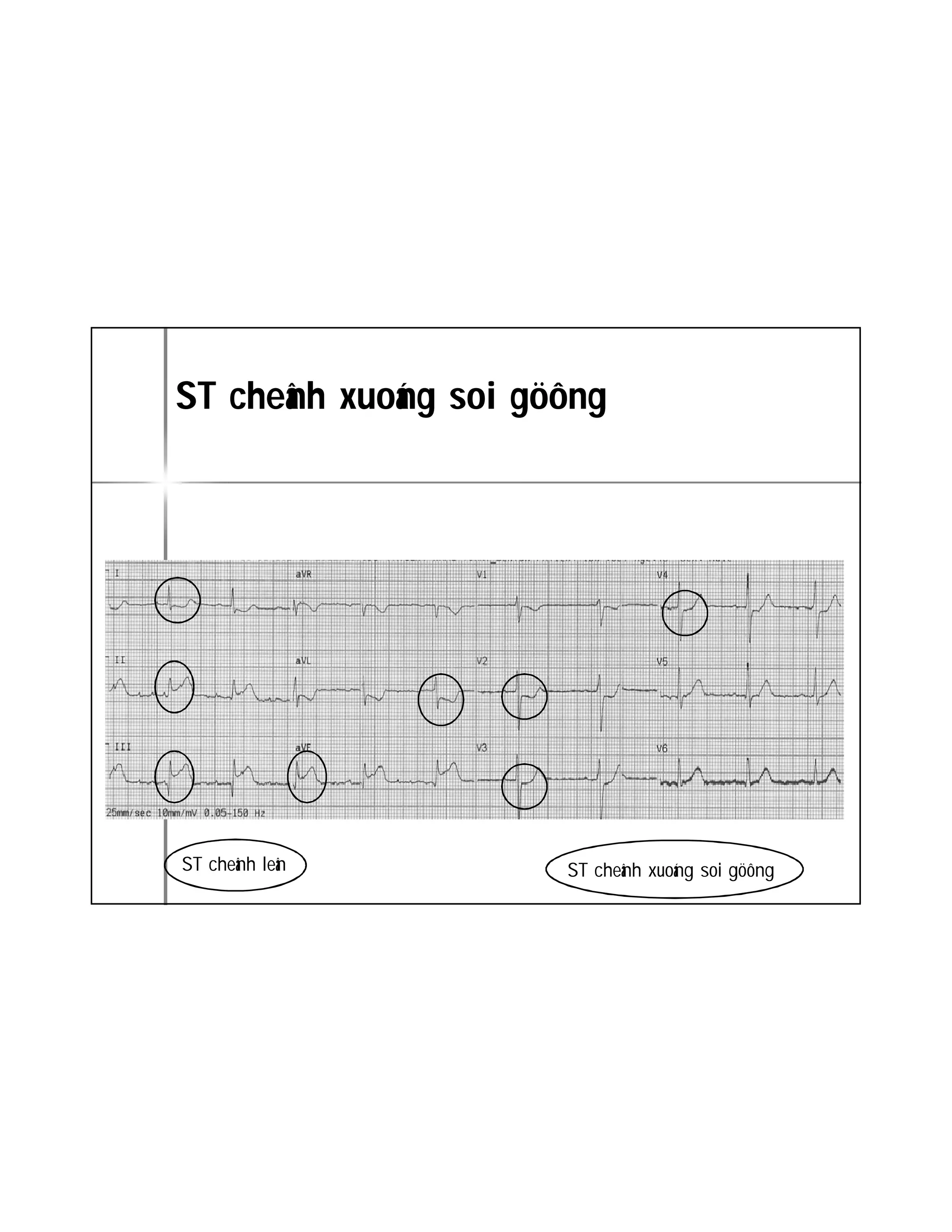 ECG TRONG STEMI | PDF