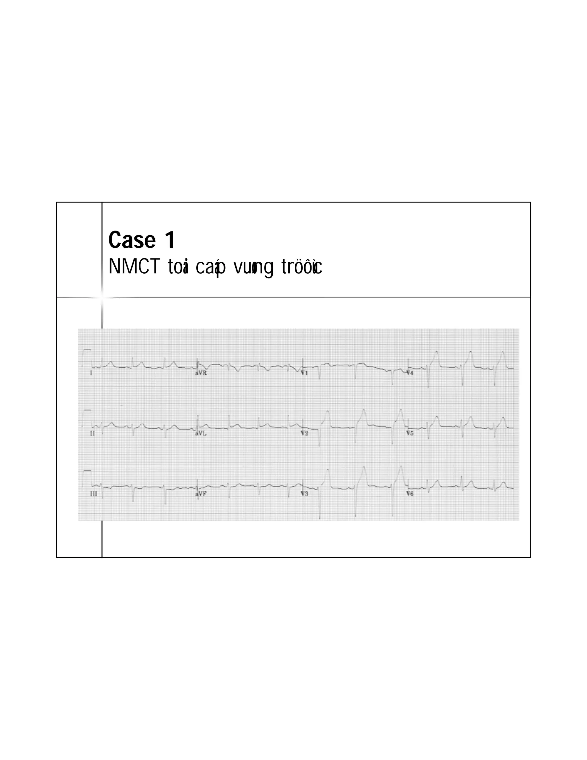 ECG TRONG STEMI | PDF