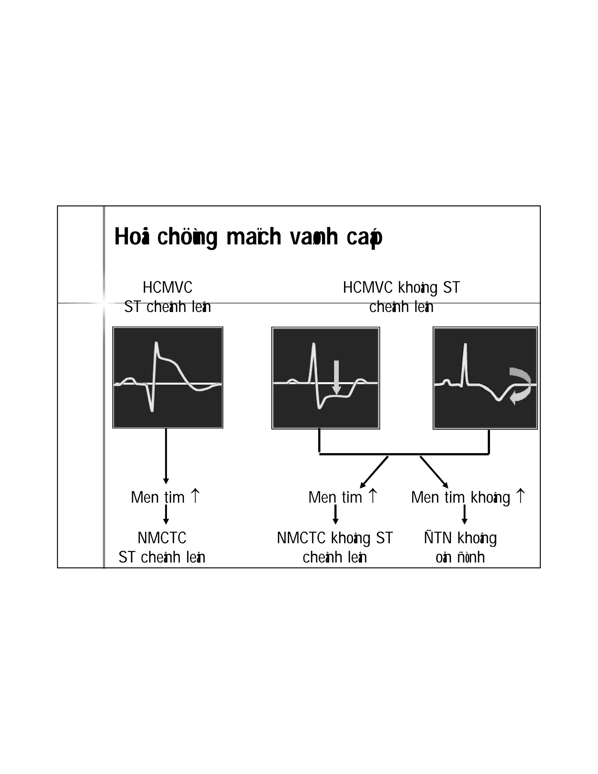 ECG TRONG STEMI | PDF