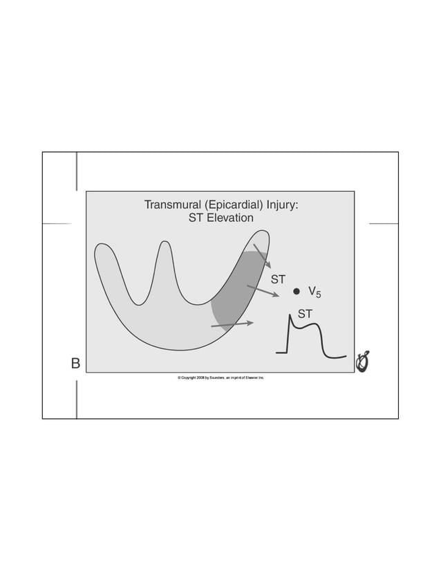 ECG TRONG STEMI | PDF