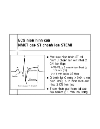 ECG TRONG STEMI | PDF