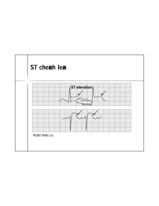 ECG TRONG STEMI | PDF