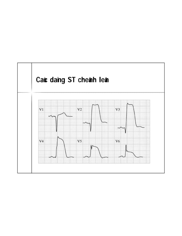 ECG TRONG STEMI | PDF