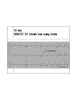 ECG TRONG STEMI | PDF