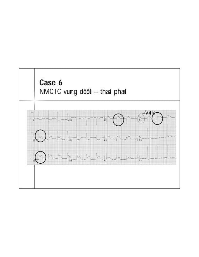 ECG TRONG STEMI | PDF