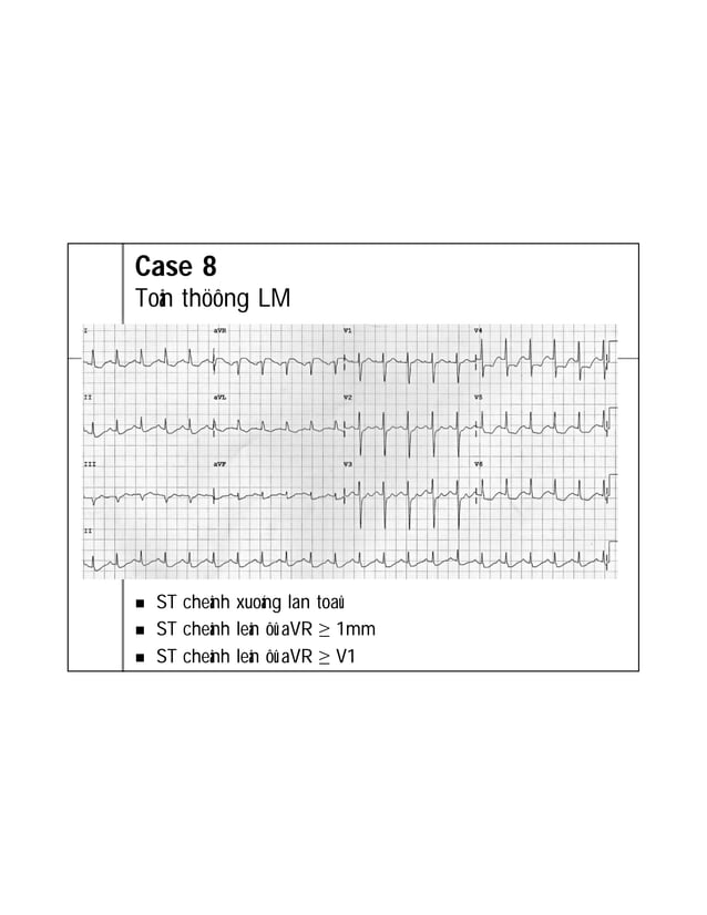ECG TRONG STEMI | PDF