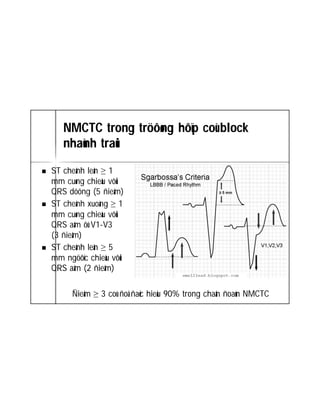 ECG TRONG STEMI | PDF