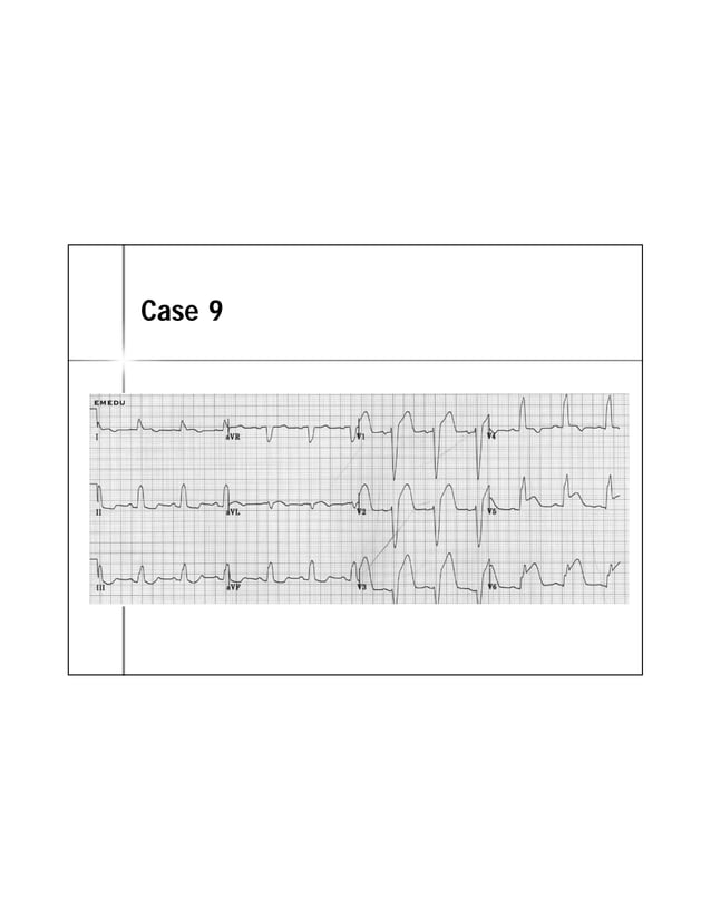 ECG TRONG STEMI | PDF