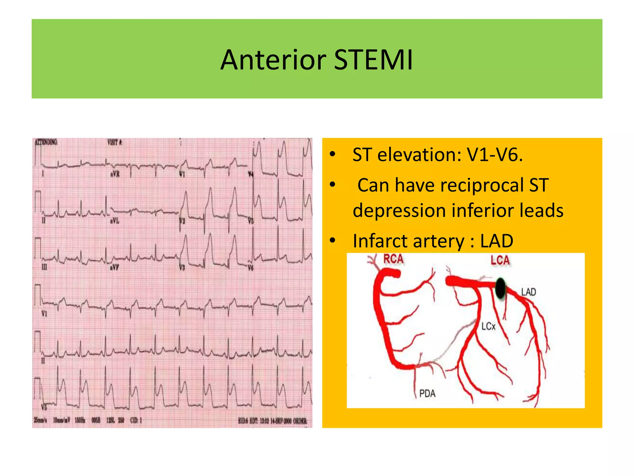 ECG IN STEMI.ppt