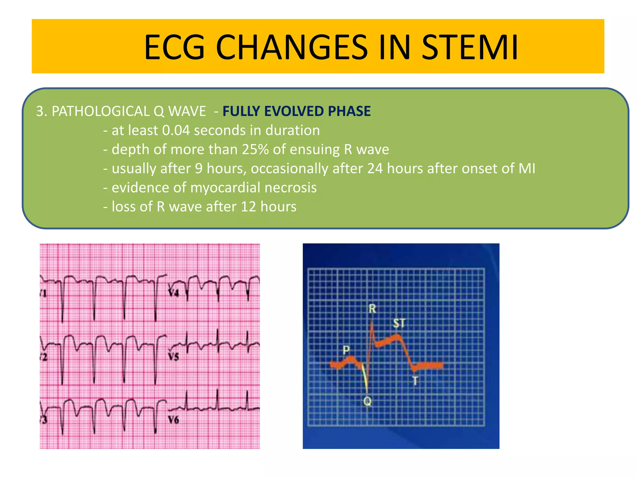 ECG IN STEMI.ppt