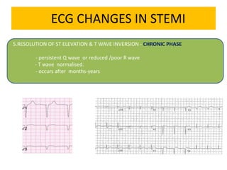 ECG IN STEMI.ppt