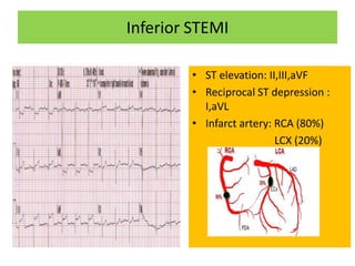 ECG IN STEMI.ppt
