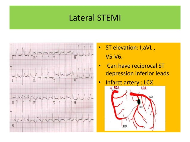 ECG IN STEMI.ppt