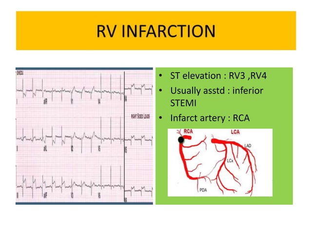 ECG IN STEMI.ppt
