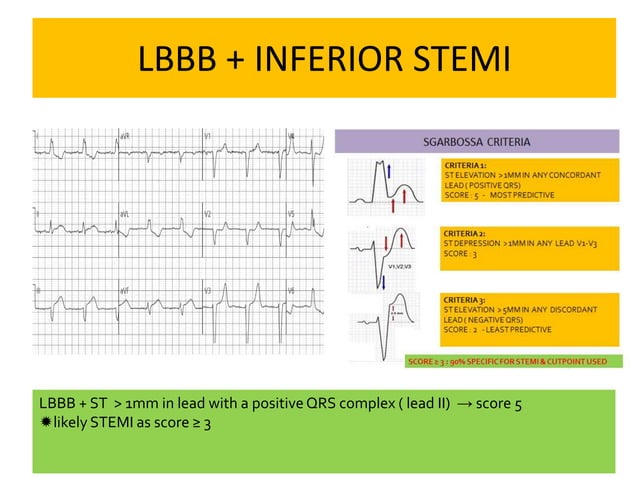 ECG IN STEMI.ppt