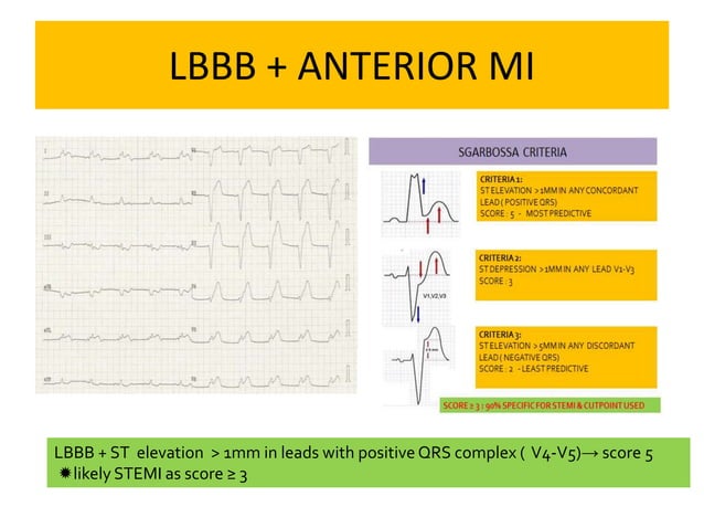 ECG IN STEMI.ppt