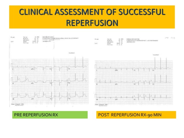 ECG IN STEMI.ppt
