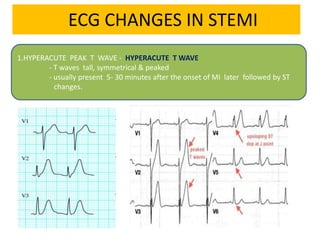 ECG IN STEMI.ppt