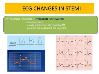 ECG IN STEMI.ppt