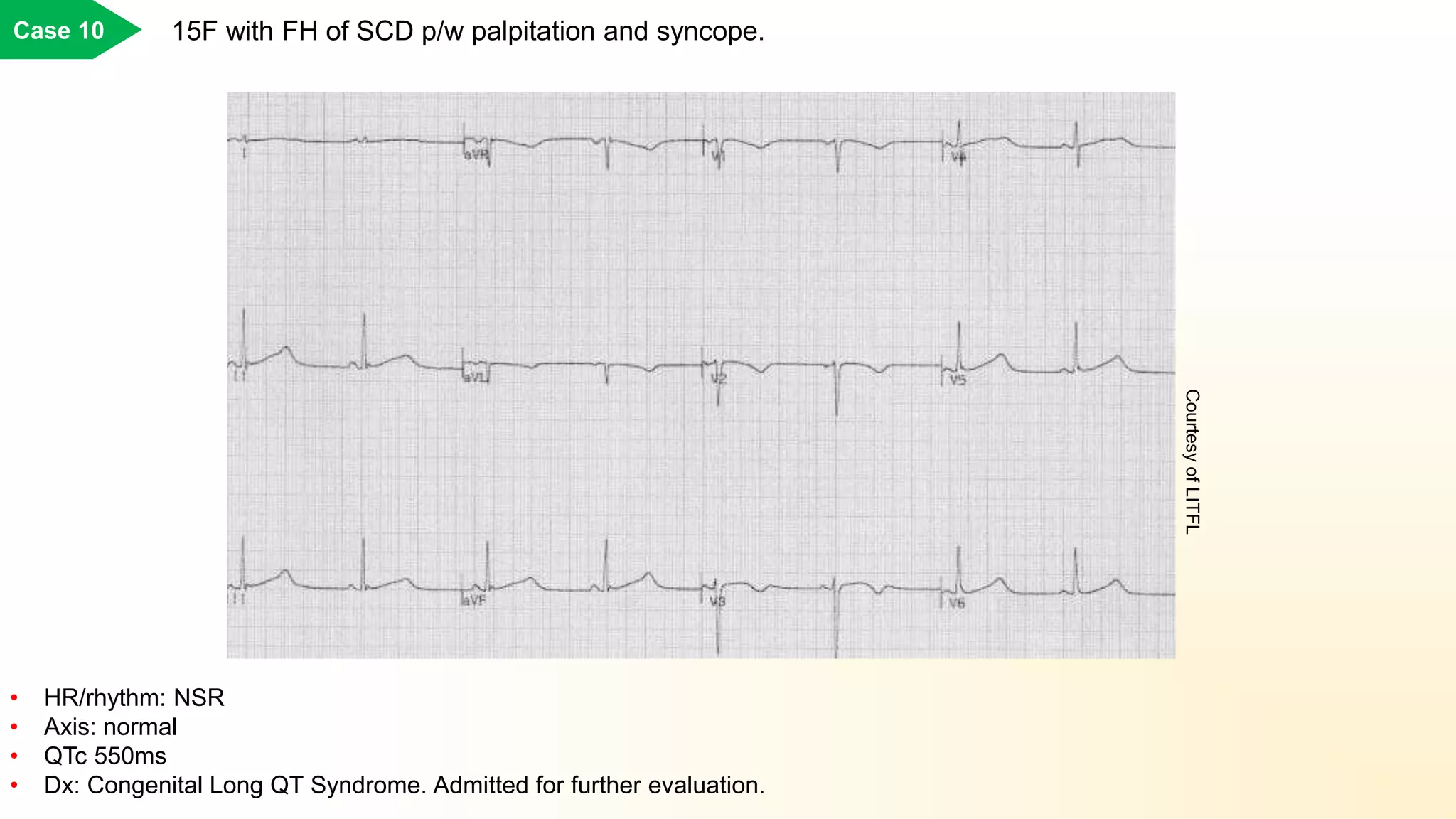 Ecg in syncope | PPTX