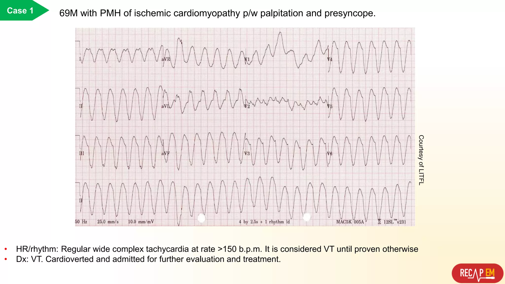 Ecg in syncope | PPTX