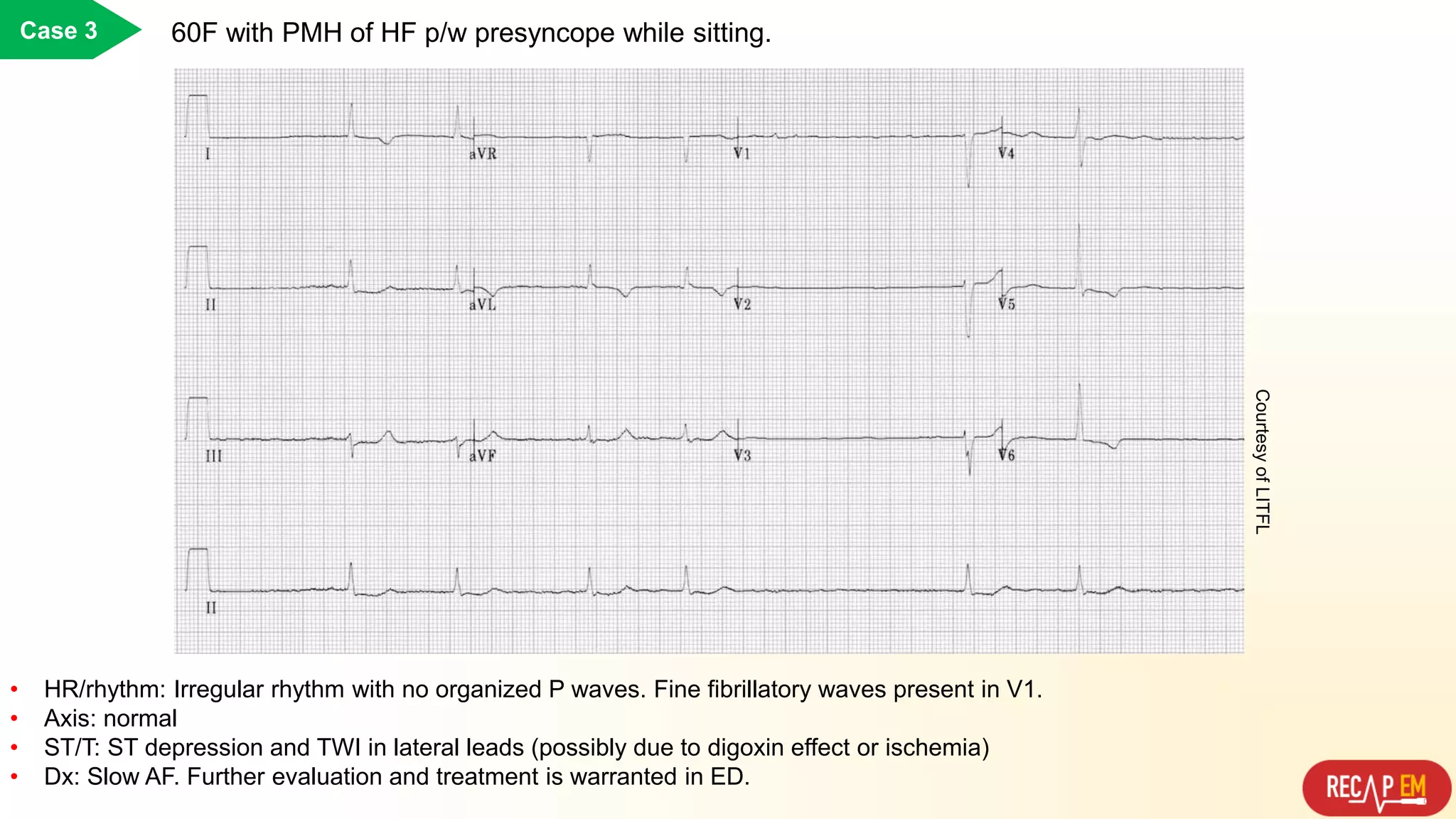 Ecg in syncope | PPTX