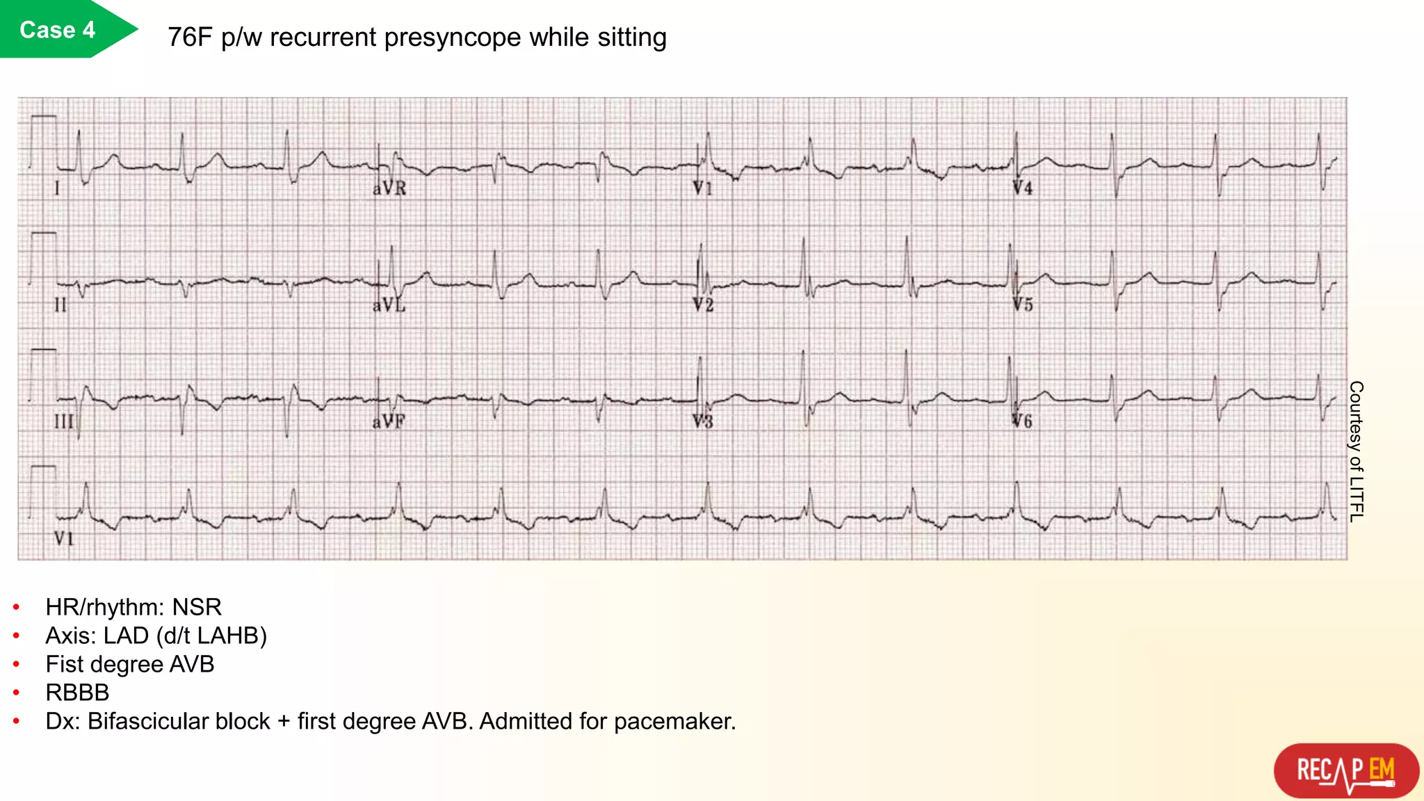 Ecg in syncope | PPTX