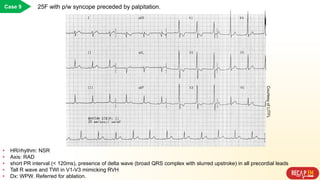 Ecg in syncope | PPTX