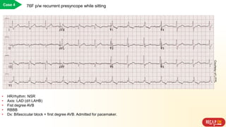 Ecg in syncope | PPTX