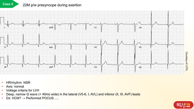 Ecg in syncope | PPT
