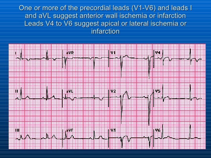 Ecg interpretation