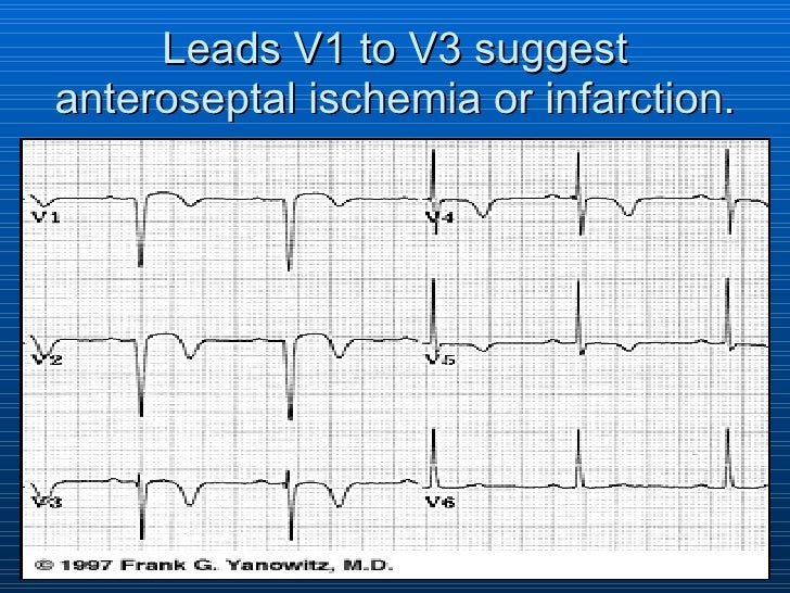 Ecg interpretation