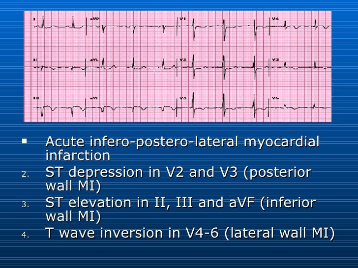Ecg interpretation
