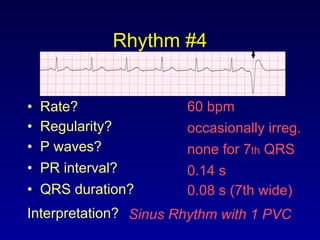 Ecg interpretation | PDF