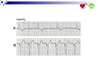 Ecg interpretation | PPT