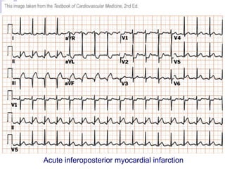 Ecg interpretation | PPT