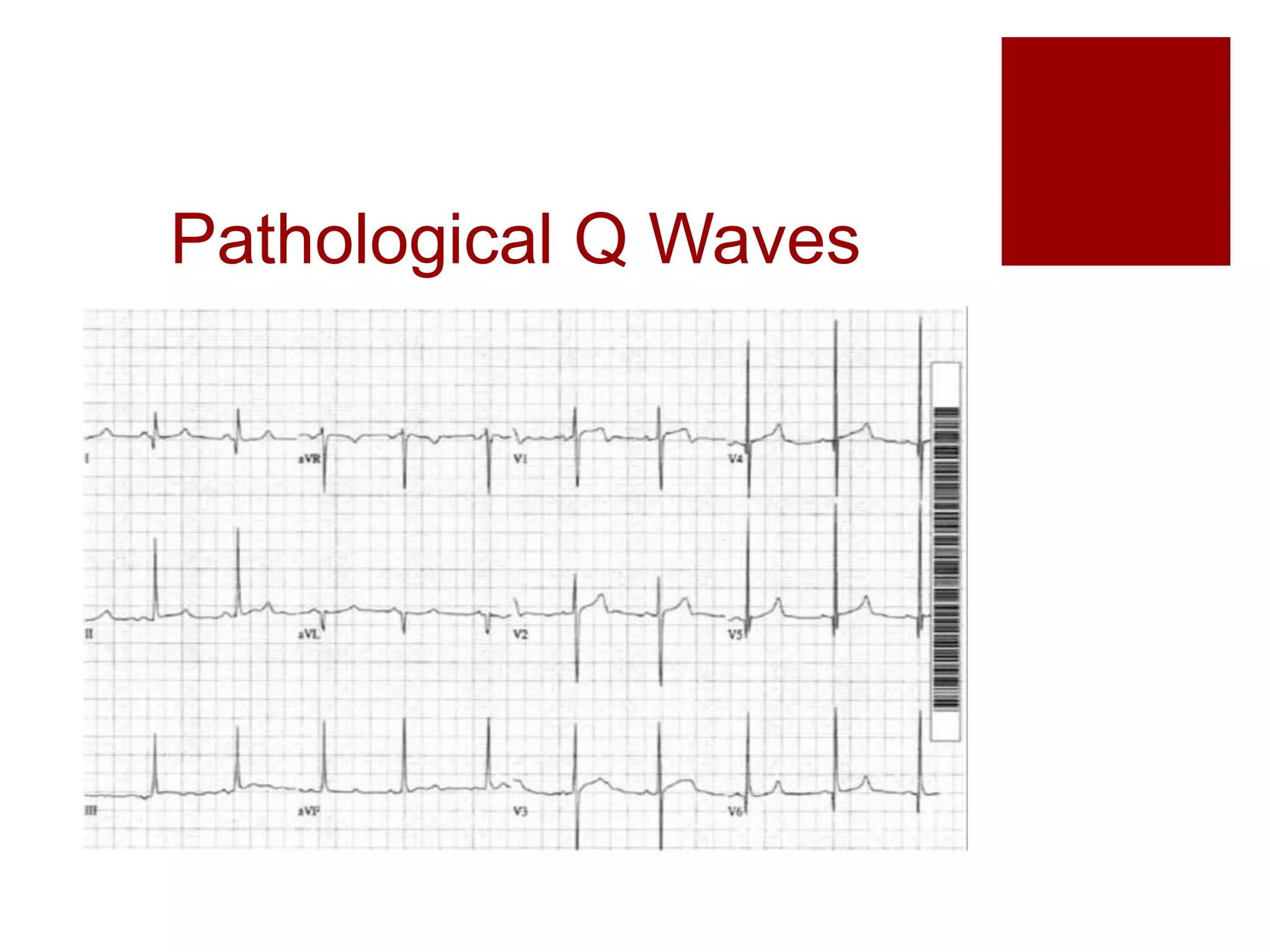 Systematic ECG Interpretation | PPTX