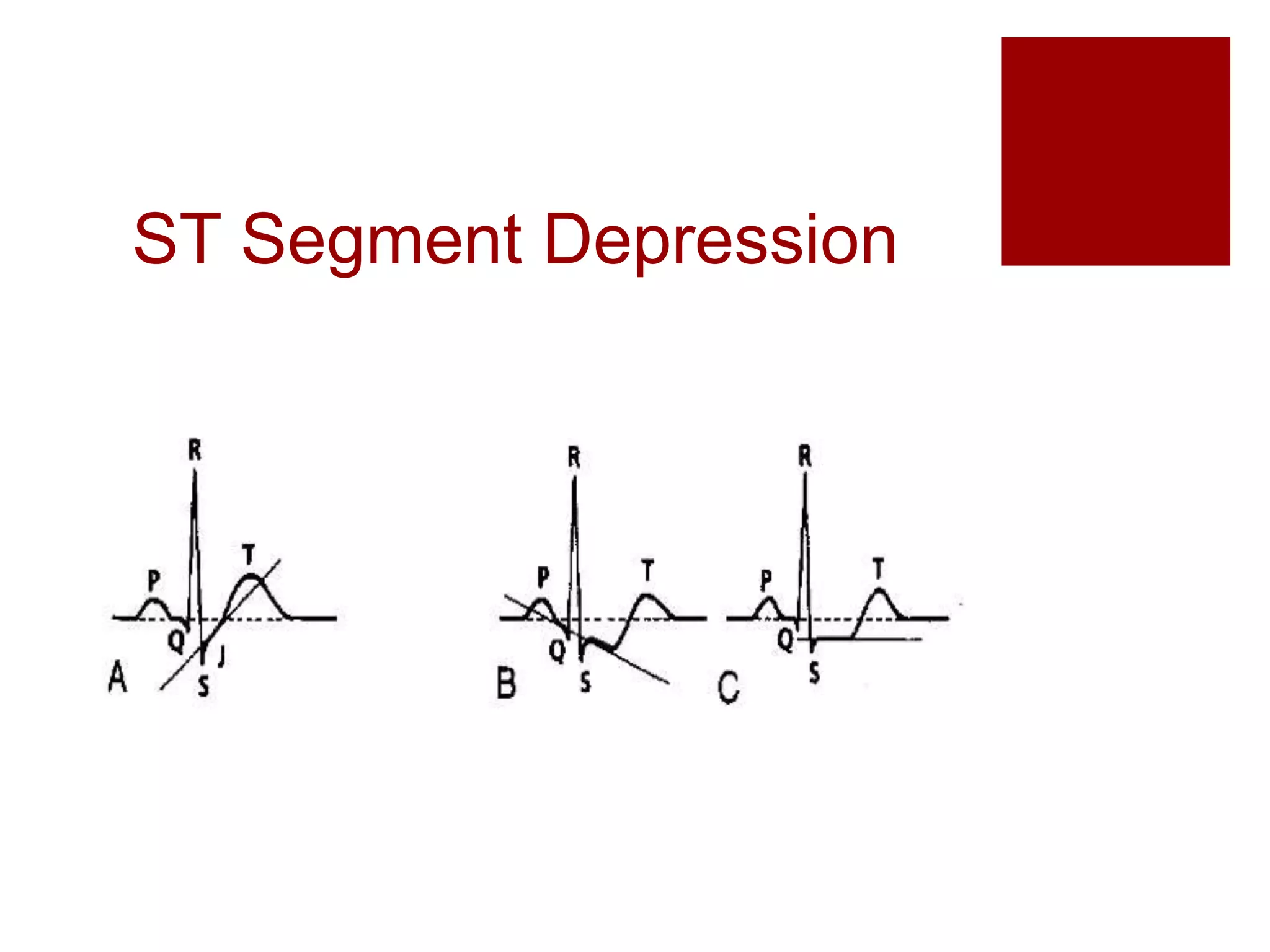 Systematic ECG Interpretation | PPTX