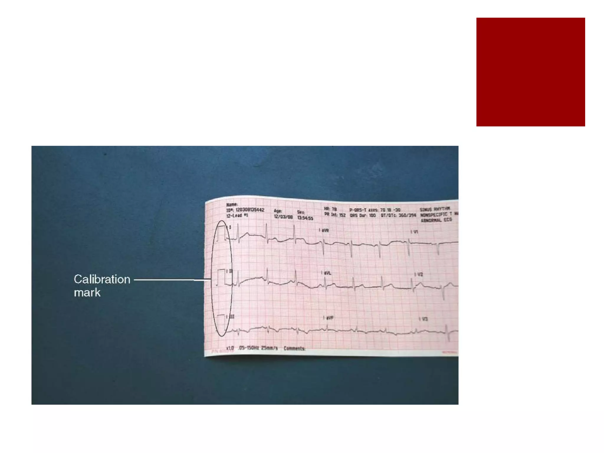 Systematic ECG Interpretation | PPTX