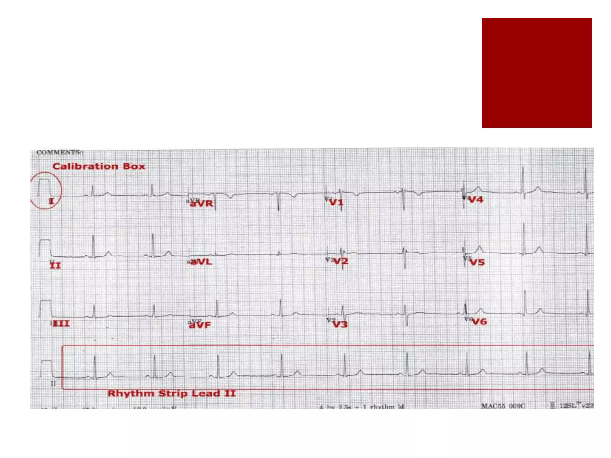 Systematic ECG Interpretation | PPTX