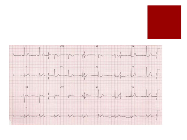Systematic ECG Interpretation | PPTX
