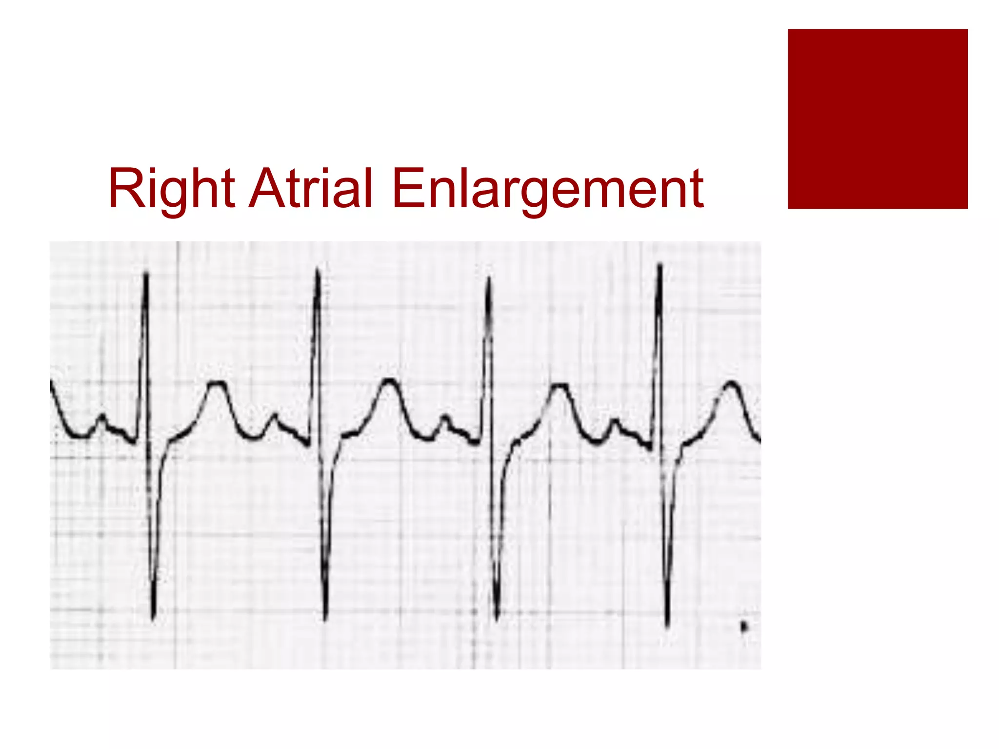 ECG interpretation | PPTX
