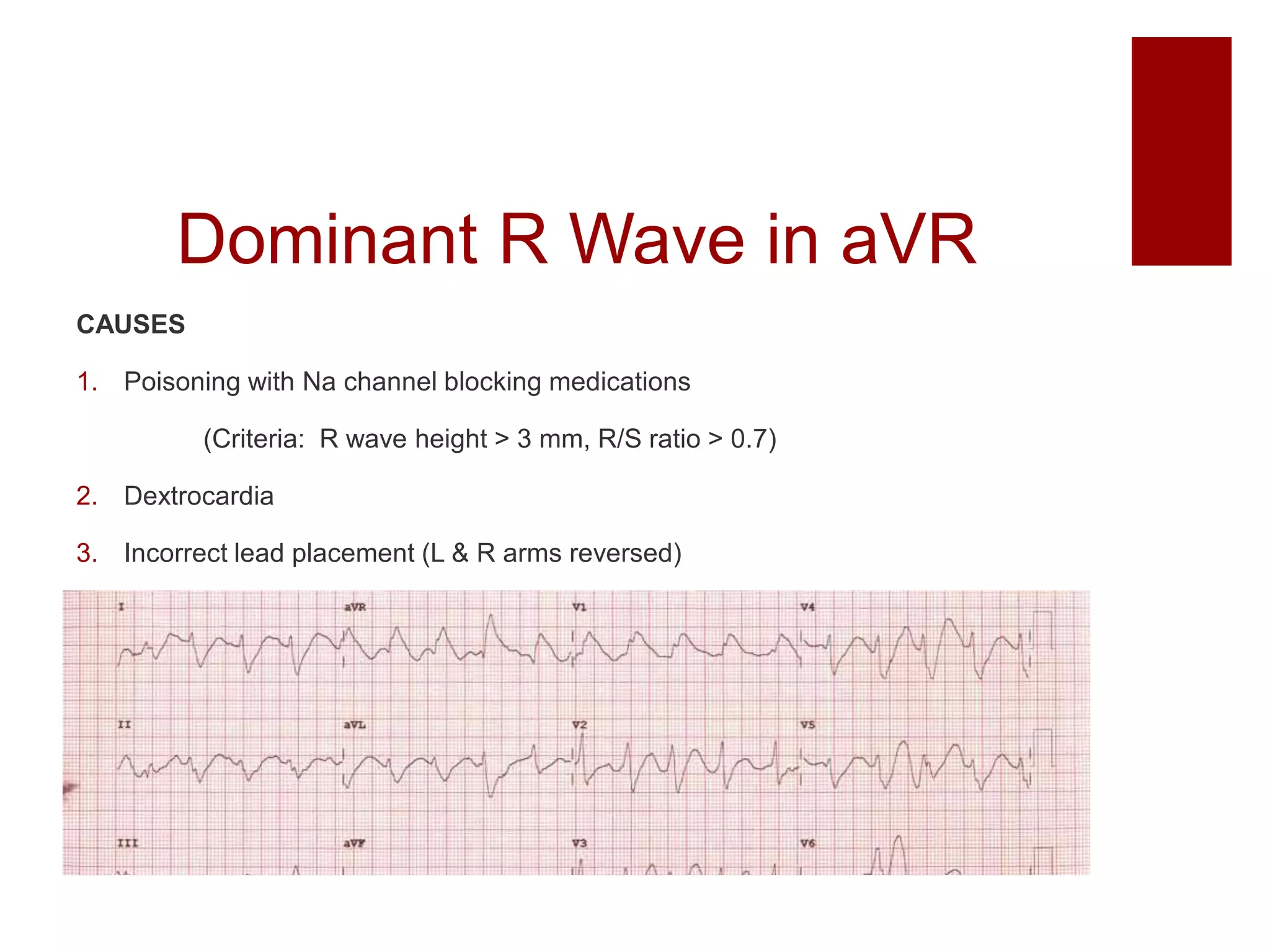 ECG interpretation | PPTX