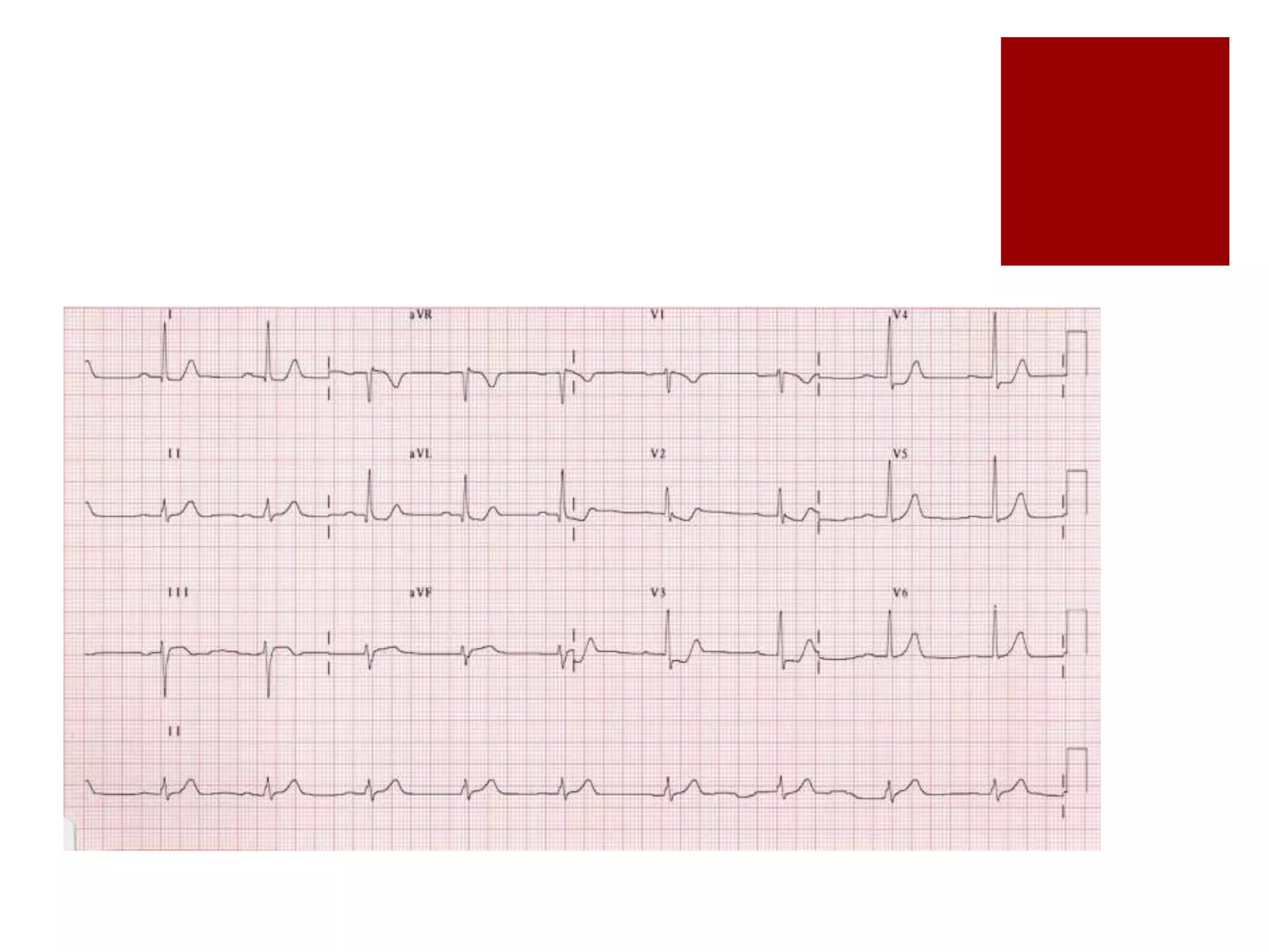 ECG interpretation | PPTX
