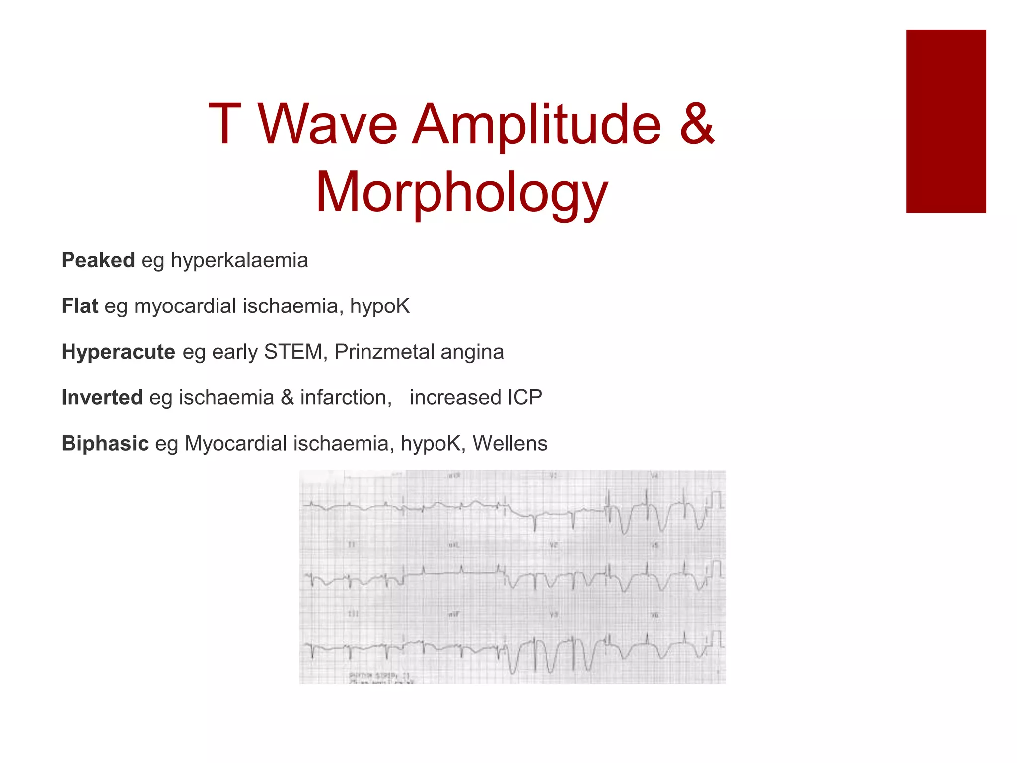 ECG interpretation | PPTX