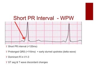 ECG interpretation | PPTX
